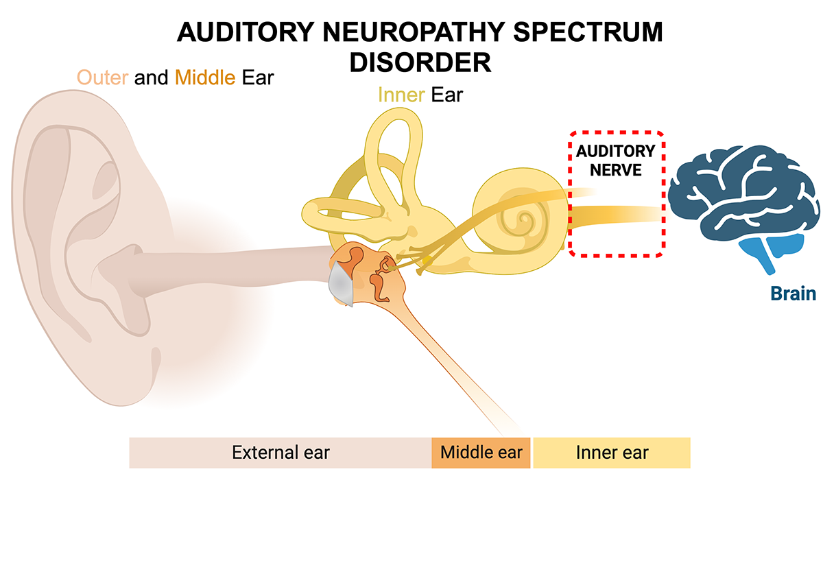 Auditory Neuropathy Syndrome – Welcome to My Deaf Baby Speaks